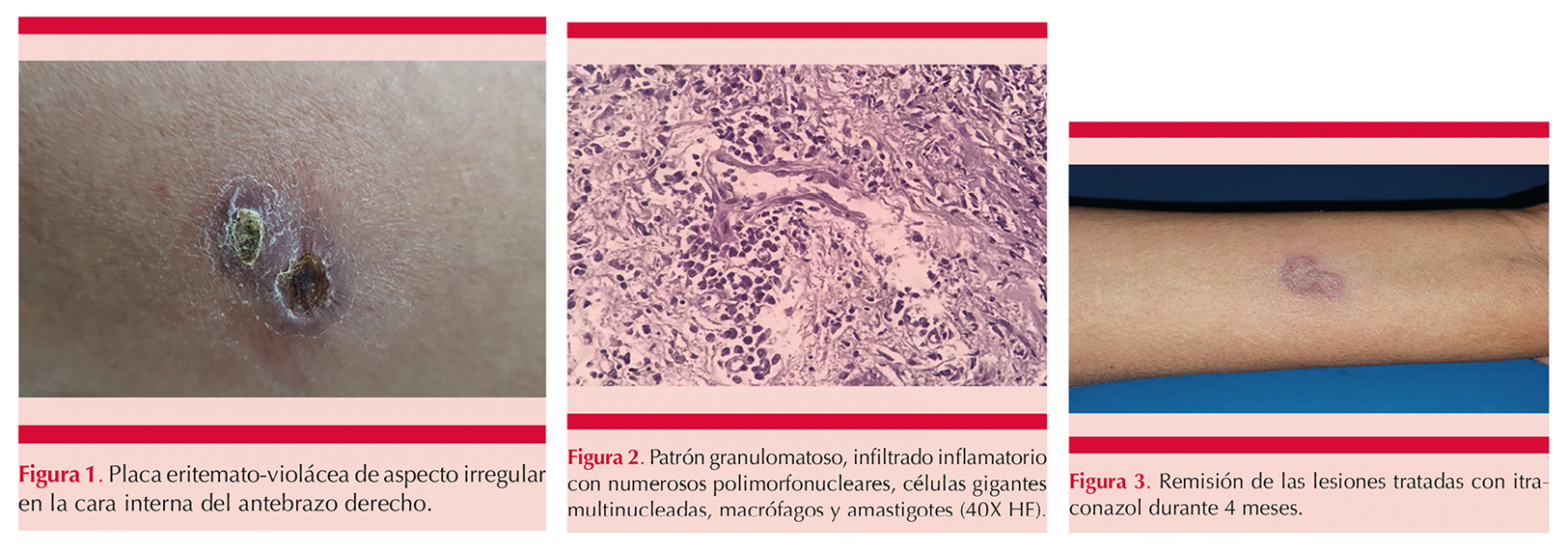 Leishmaniasis cutánea: alternativas terapéuticas – Dermatología Revista ...