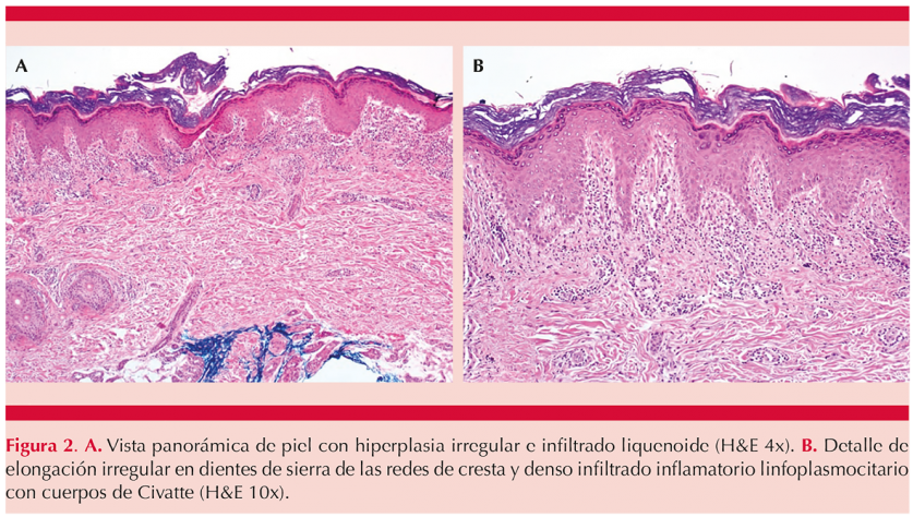 Liquen plano anular y atrófico: una variante rara de liquen plano ...