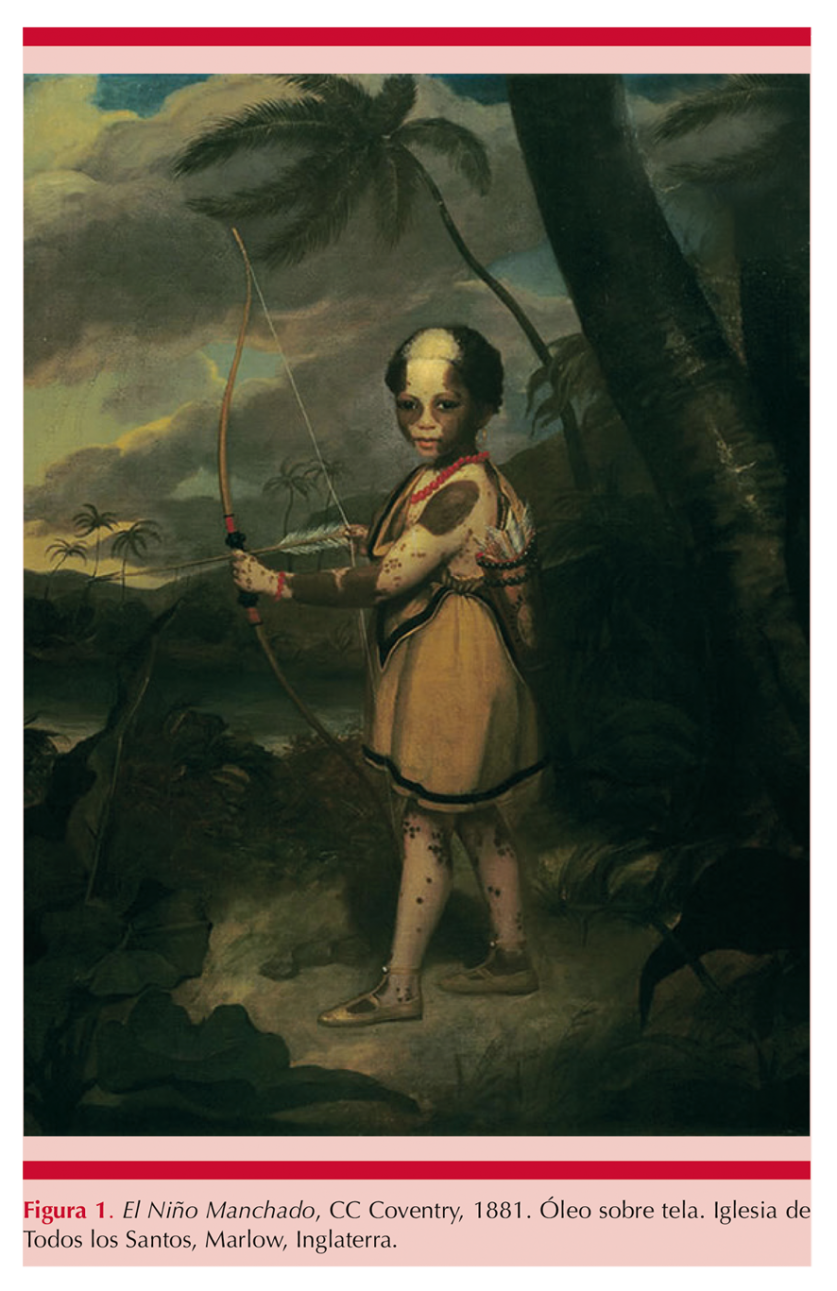 El Niño Manchado – Dermatología Revista mexicana