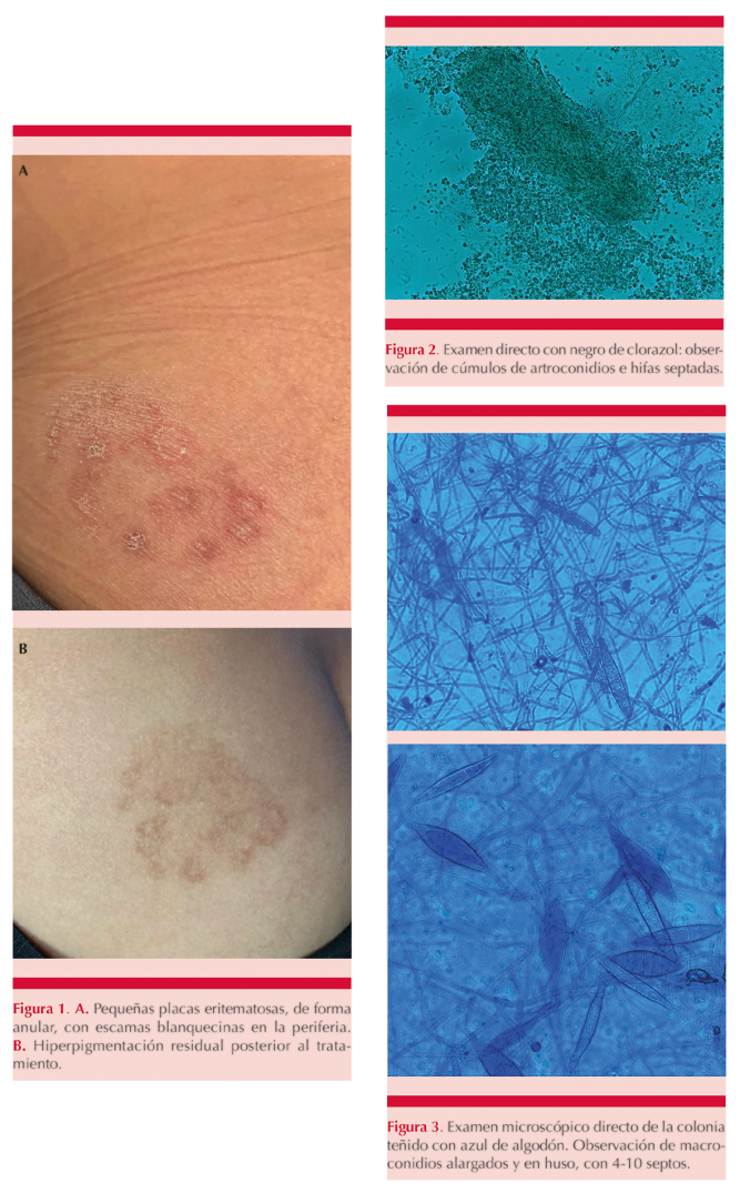 Dermatofitosis cutánea atípica con dermatofitoma en un paciente ...