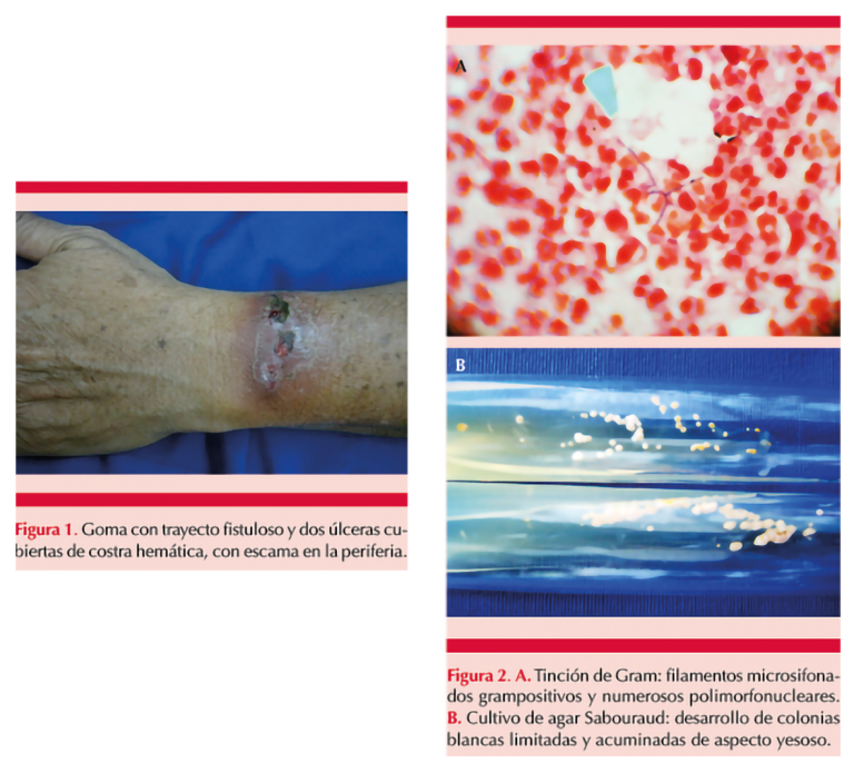 Nocardiosis cutánea primaria – Dermatología Revista mexicana