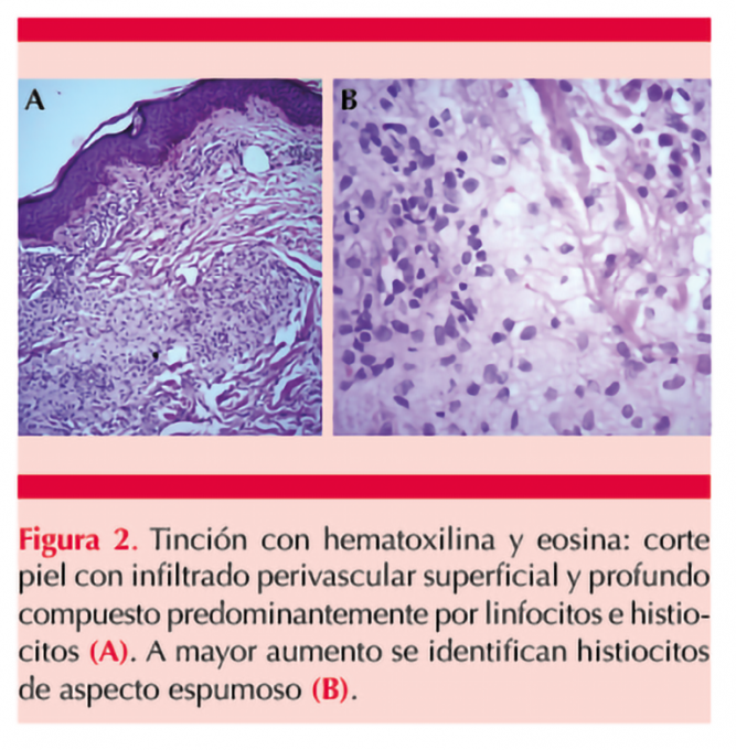 Xantoma eruptivo: ¿cómo hacer el abordaje de hipertrigliceridemia por ...