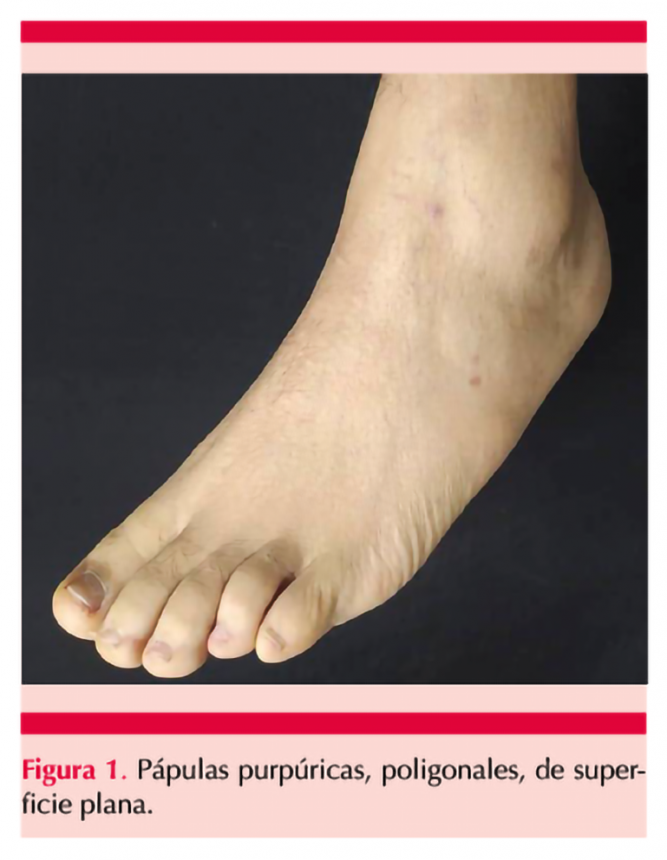 Manifestación clásica del liquen plano simple – Dermatología Revista ...