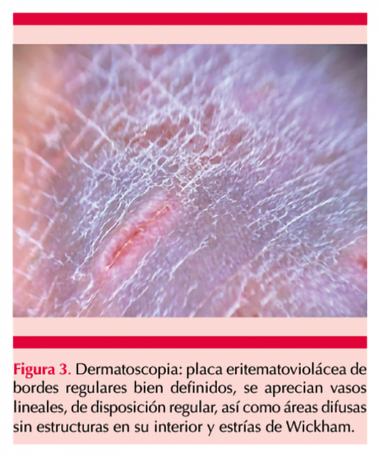 Manifestación clásica del liquen plano simple – Dermatología Revista mexicana