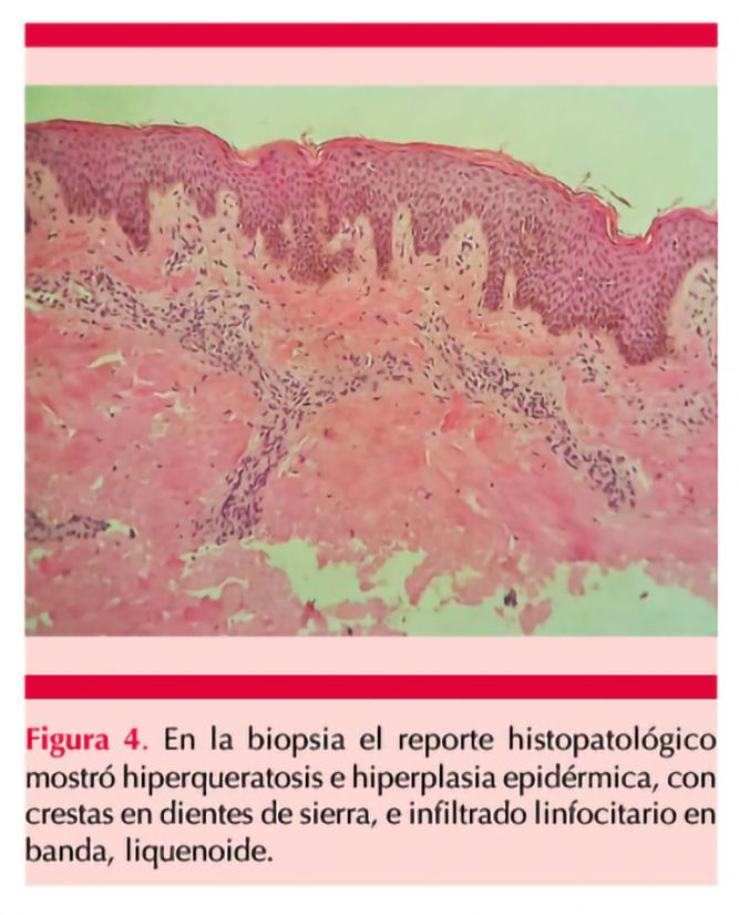 Manifestación clásica del liquen plano simple – Dermatología Revista ...