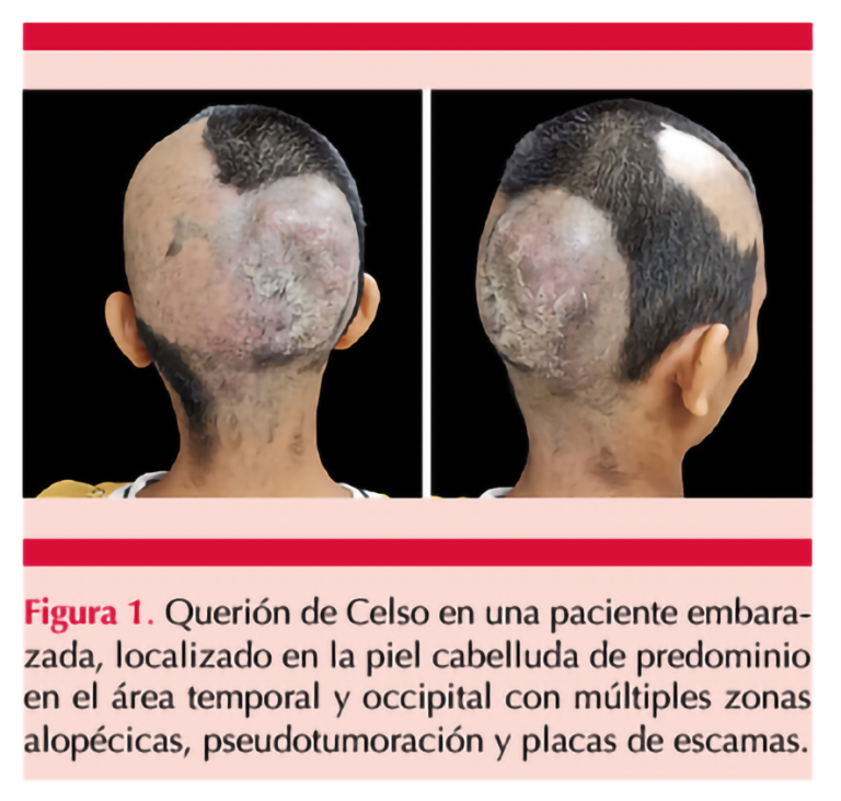 Querión de Celso en el embarazo tratado con terbinafina – Dermatología ...