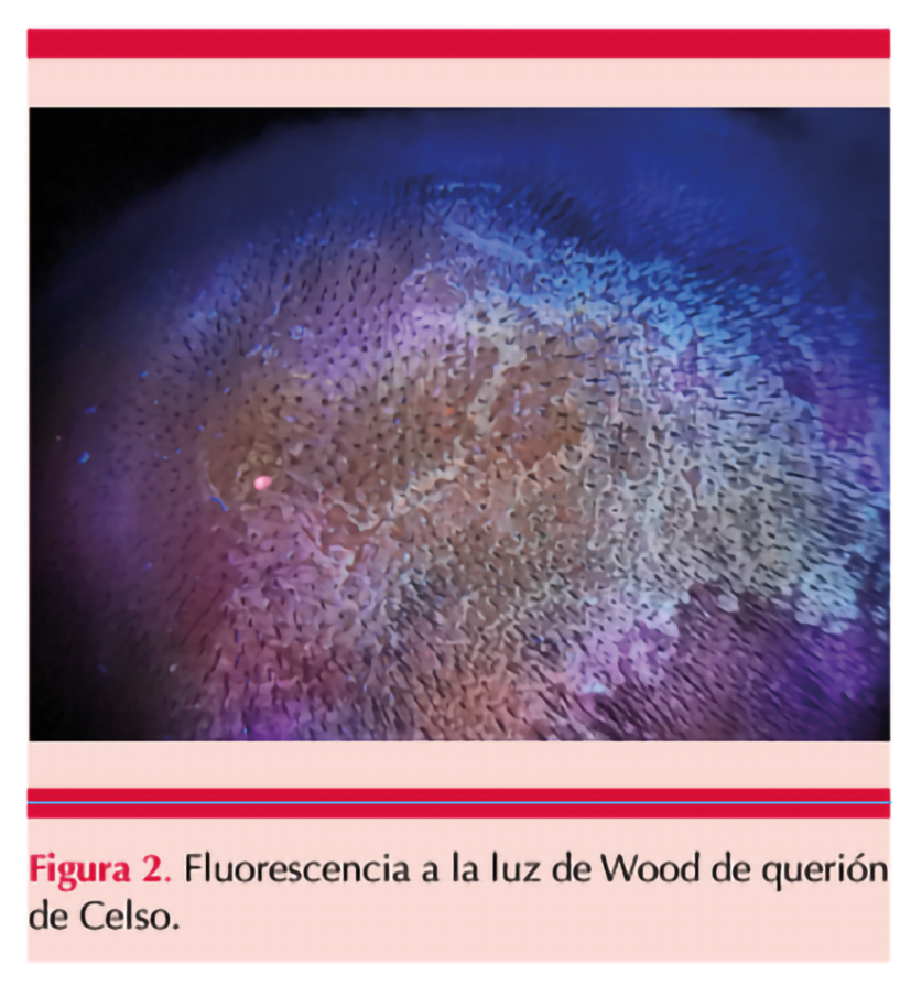 Querión de Celso en el embarazo tratado con terbinafina – Dermatología ...