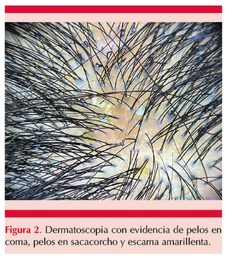 ¿Foliculitis decalvante o tiña inflamatoria? – Dermatología Revista ...