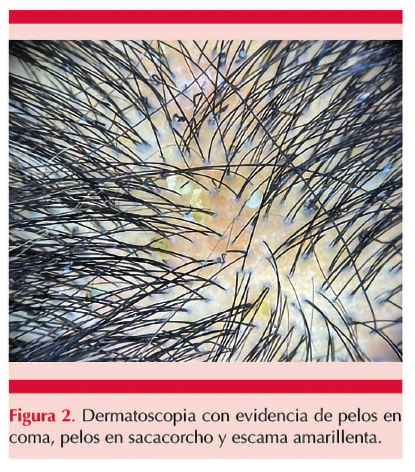 ¿Foliculitis decalvante o tiña inflamatoria? – Dermatología Revista ...