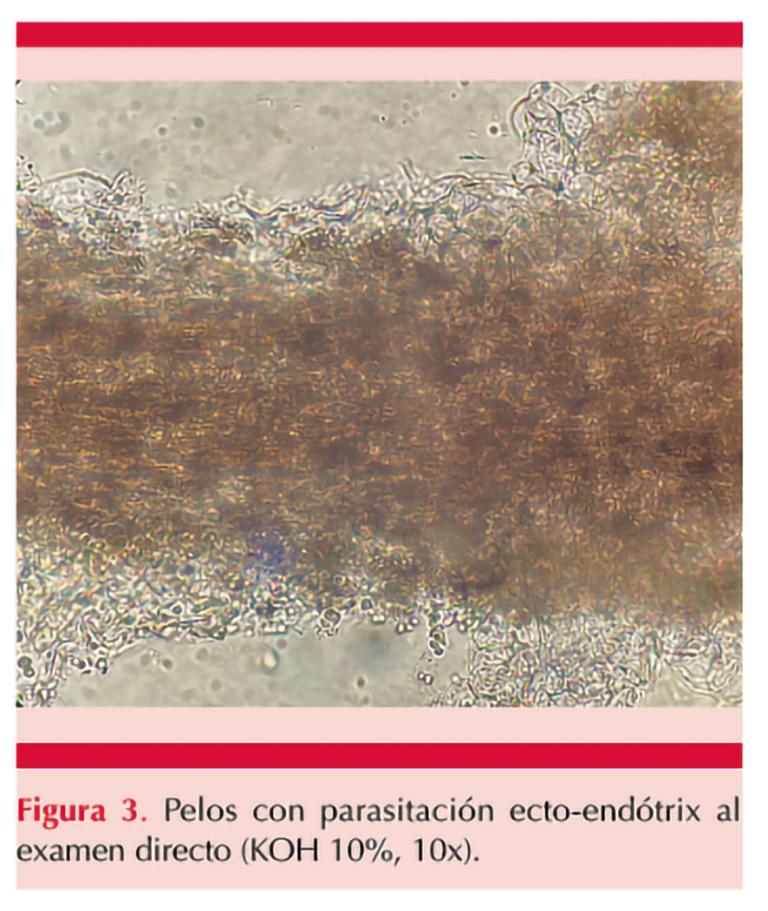 ¿Foliculitis decalvante o tiña inflamatoria? – Dermatología Revista ...