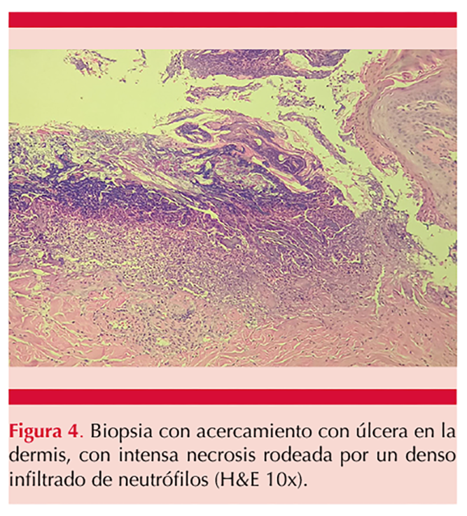Pioderma gangrenoso: un caso de tratamiento exitoso con ...