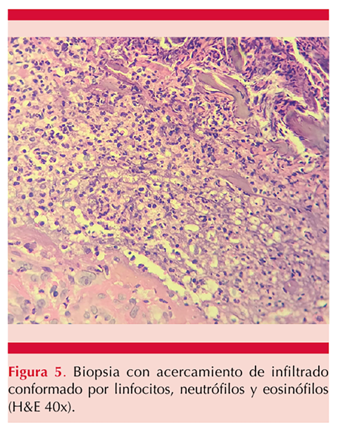 Pioderma gangrenoso: un caso de tratamiento exitoso con ...