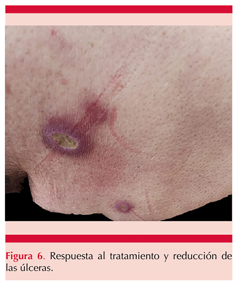 Pioderma gangrenoso: un caso de tratamiento exitoso con ...