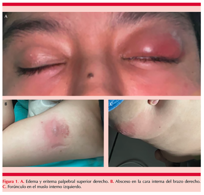 Isotretinoína y forunculosis: un efecto a considerar – Dermatología ...