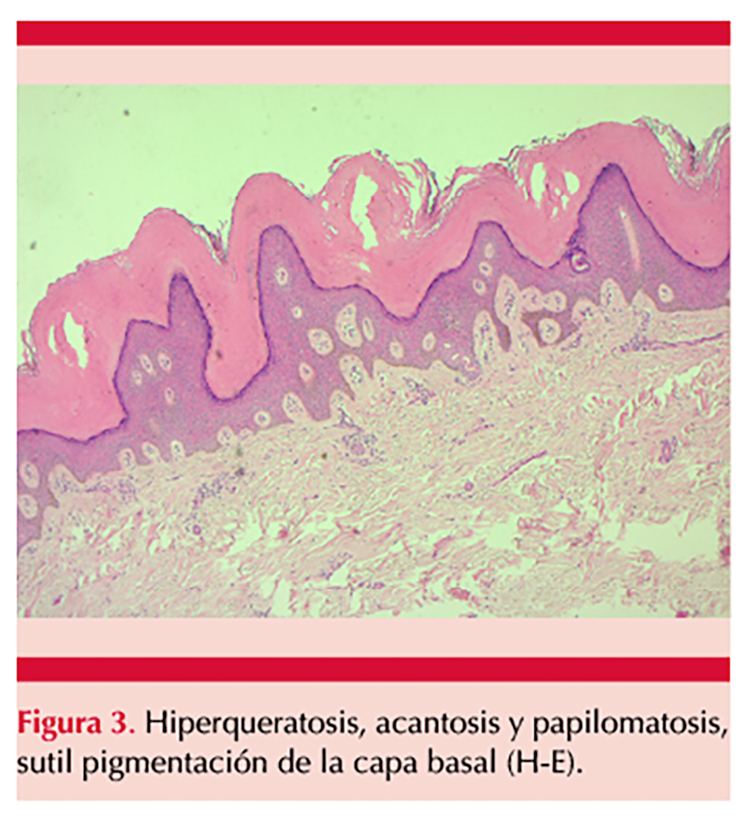 Acantosis nigricans maligna como manifestación inicial de carcinoma ...