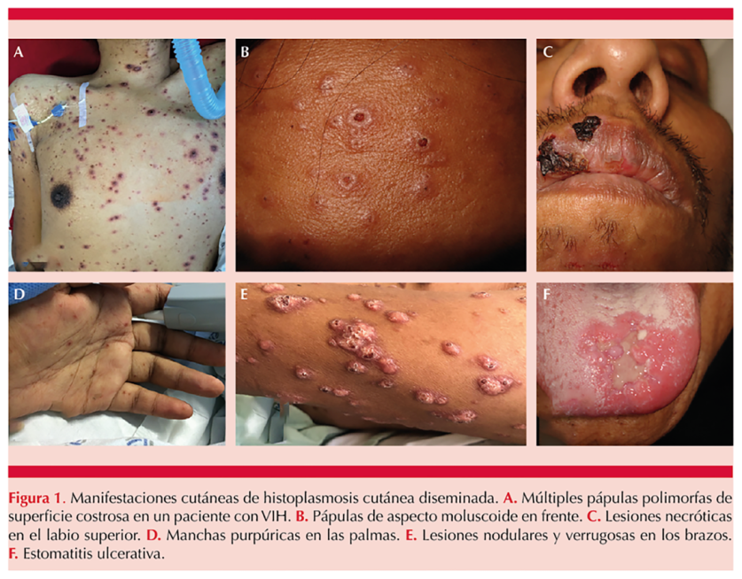 Comportamiento de la histoplasmosis cutánea diseminada asociada con el inicio del VIH-SIDA ...