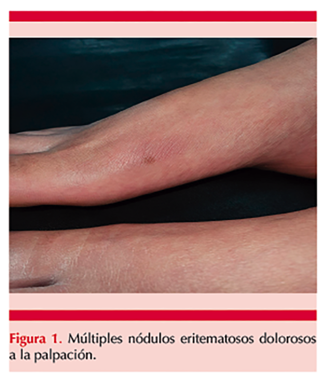 Eritema nodoso secundario a colpitis resistente por Chlamydia ...