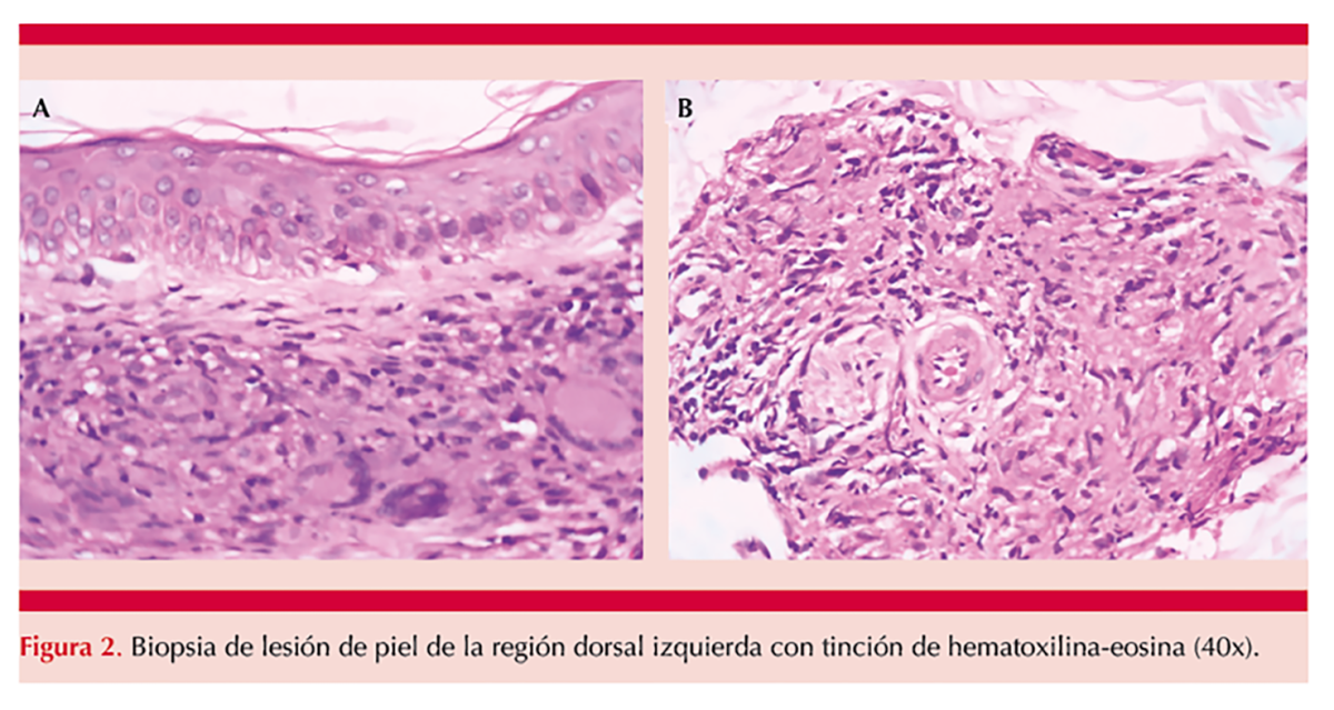 Lepra: una enfermedad olvidada y no erradicada – Dermatología Revista ...