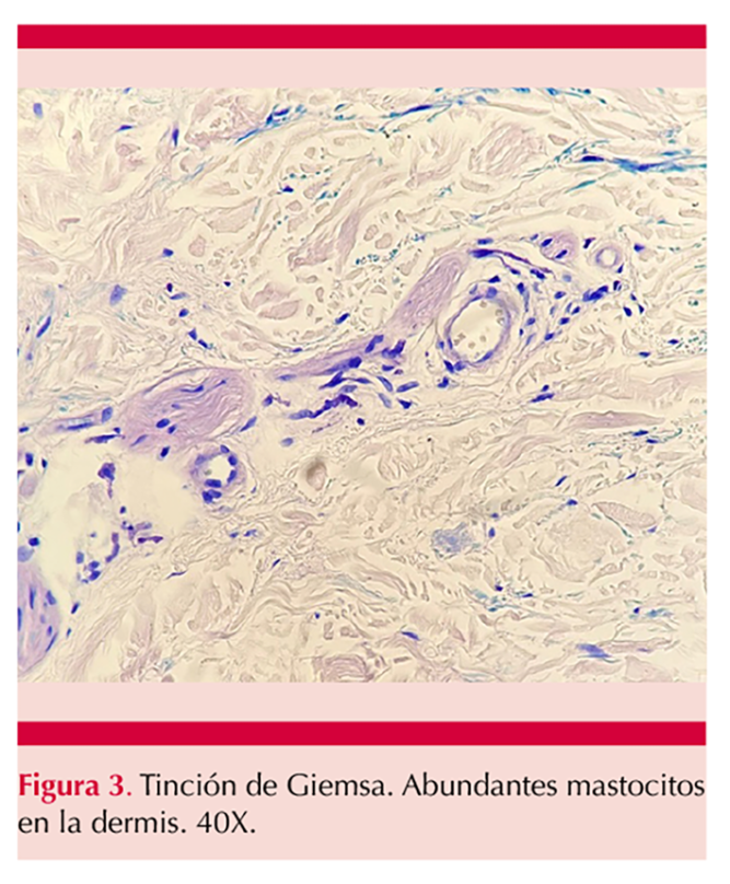 Telangiectasia macular eruptiva perstans unilateral con urticaria ...
