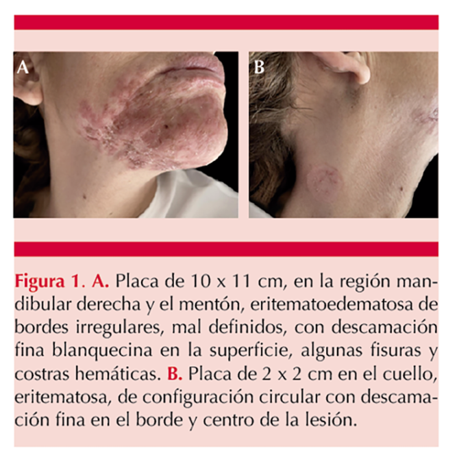 Granuloma de Majocchi facial causado por un microorganismo inusual ...