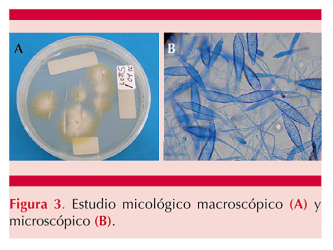 Granuloma de Majocchi facial causado por un microorganismo inusual ...