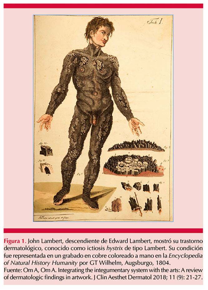 El caso de Edward Lambert “el hombre puercoespín”: historia y actualización de una dermatosis ...