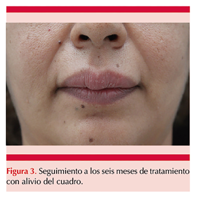 Queilitis granulomatosa de Miescher como causa de tumefacción labial ...